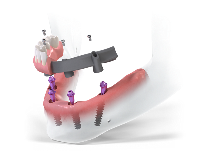 Soluciones fijas Straumann® Pro Arch